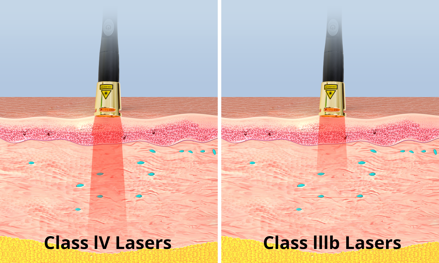 The Truth About Class IV Lasers – MateLaser