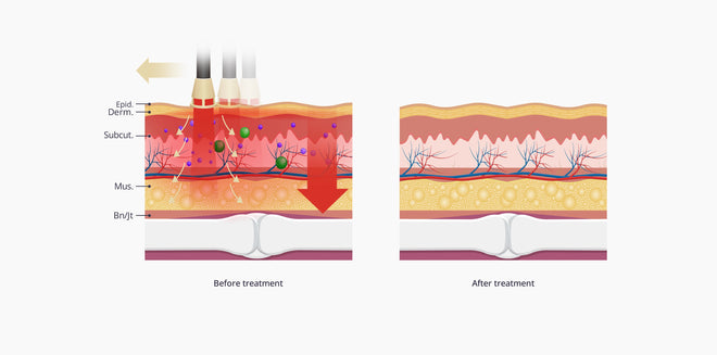 Laser Therapy – MateLaser